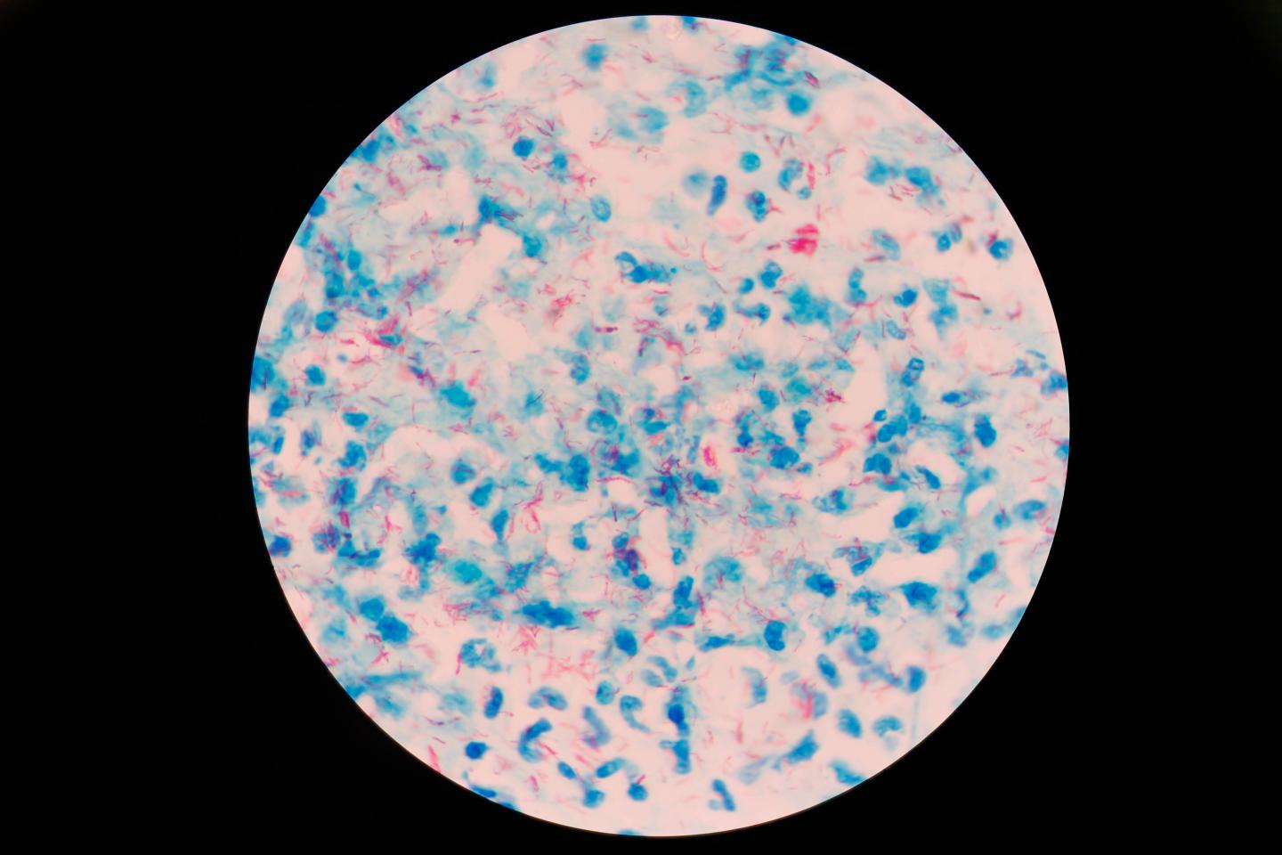 Why TB and HIV Occur Together So Often | Cell And Molecular Biology