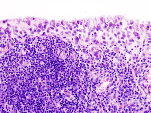 Targeting the Root Cause of Rheumatoid Arthritis | Immunology