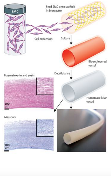 Regenerative Medicine: Bioengineered Blood Vessels | Health And Medicine