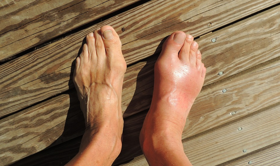 Gout Risk Linked to Small Genetic Change | Genetics And Genomics