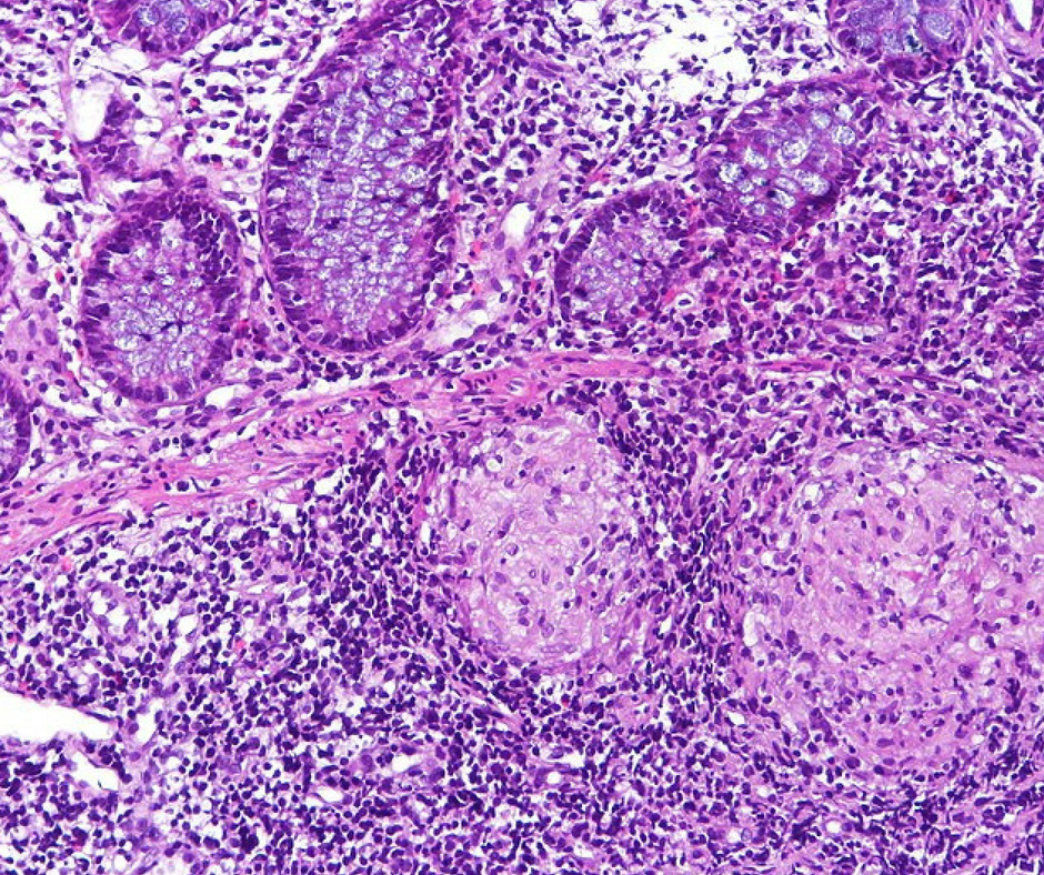 CD4 T Cells Responsible for Inflammatory Bowel Disease | Immunology