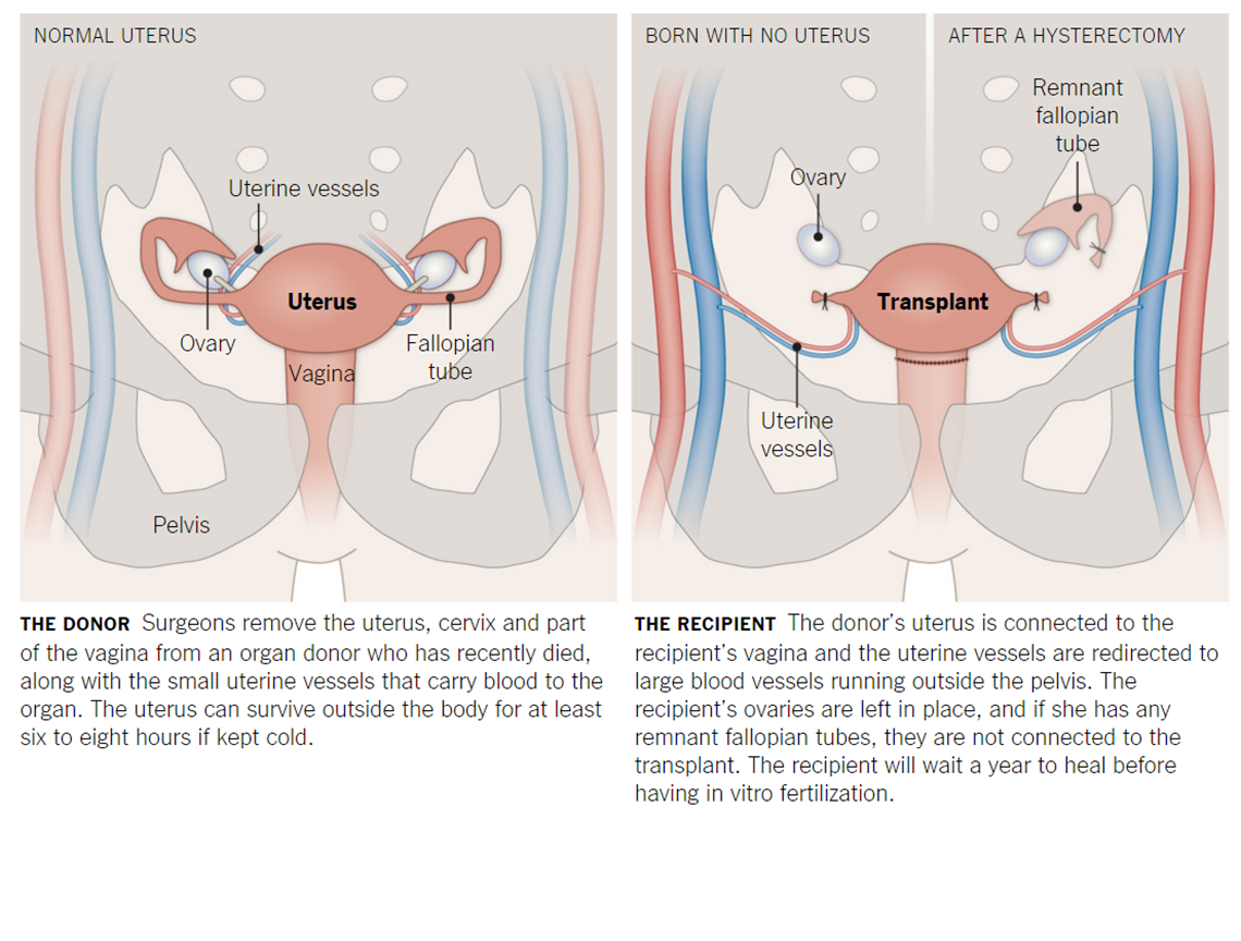 Fertility for Infertile Women: Uterus Transplant | Clinical And ...