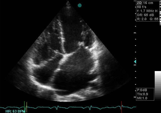 Improving Prevention Measures for Rheumatic Heart Disease | Cardiology